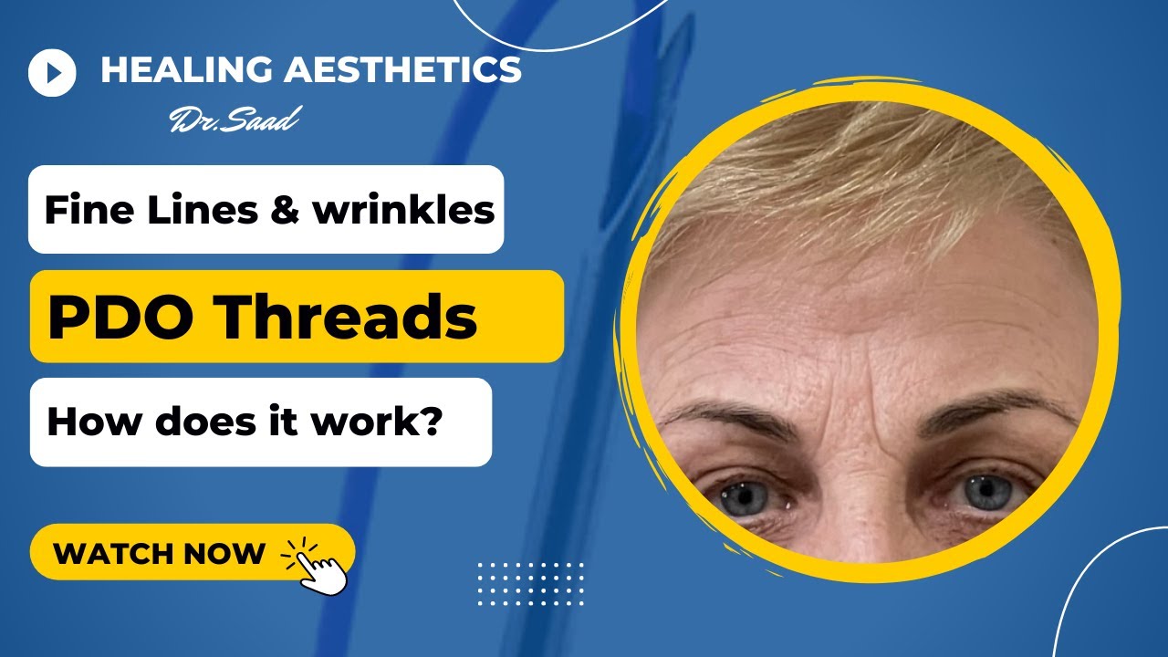 How to get rid of the stubborn 11's (Glabellar Lines) ? filler versus PDO threads - YouTube