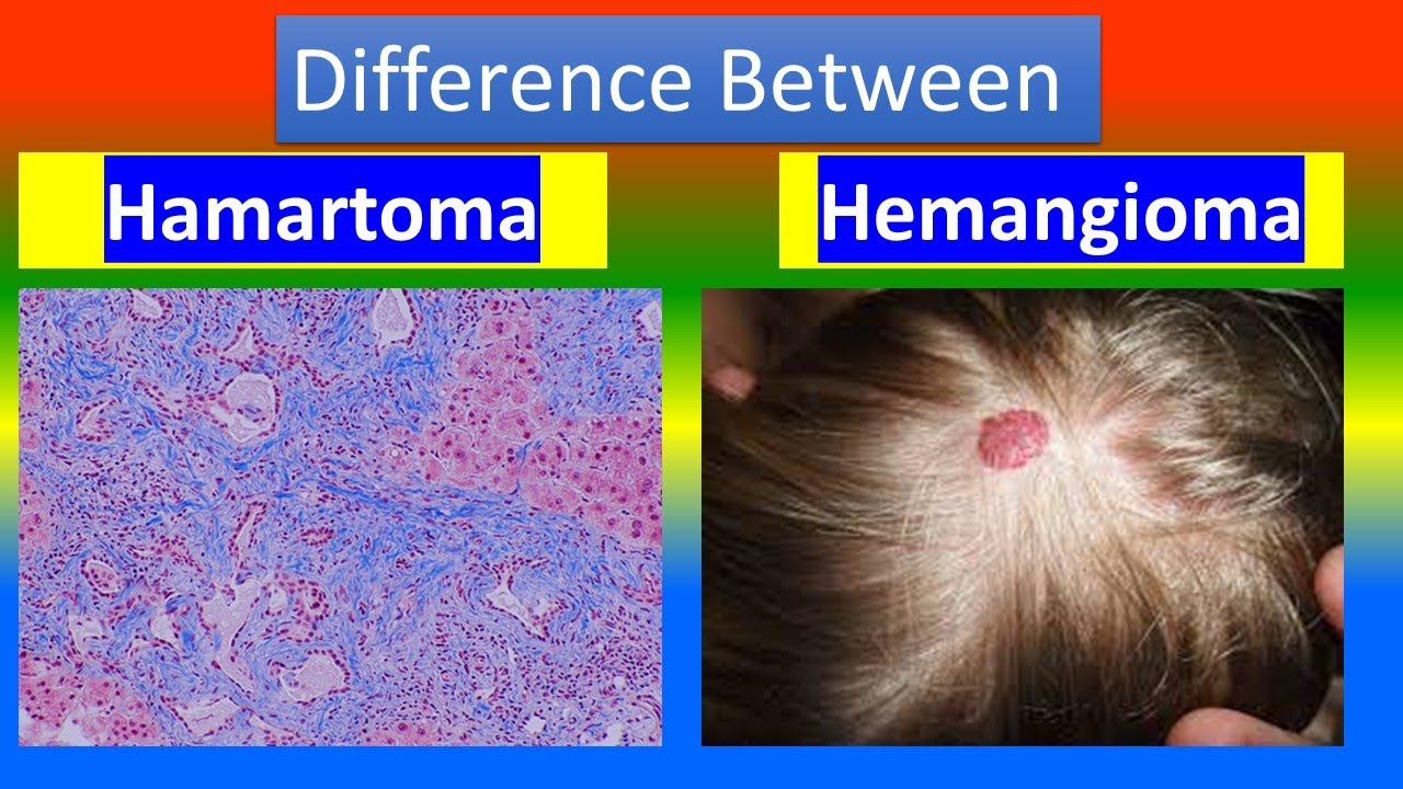 HAMARTOMA Vs. HEMANGIOMA - YouTube