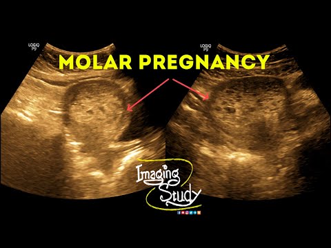 Molar Pregnancy || Hydatidiform Mole || Gestational Trophoblastic Disease || Ultrasound || Case 38