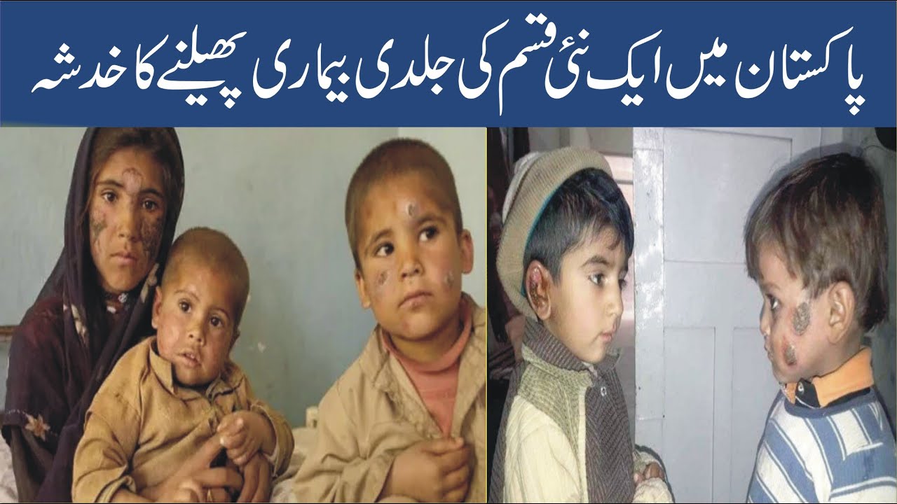 A new type of skin disease is feared to spread in Pakistan (National ...