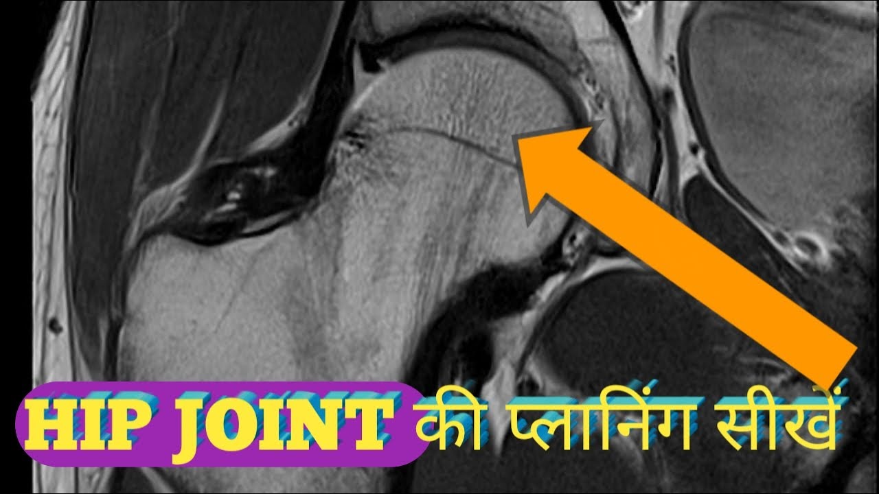 Mri # HIP JOINT # planning on 1.5 Tesla PHILIPS software machine in a ...