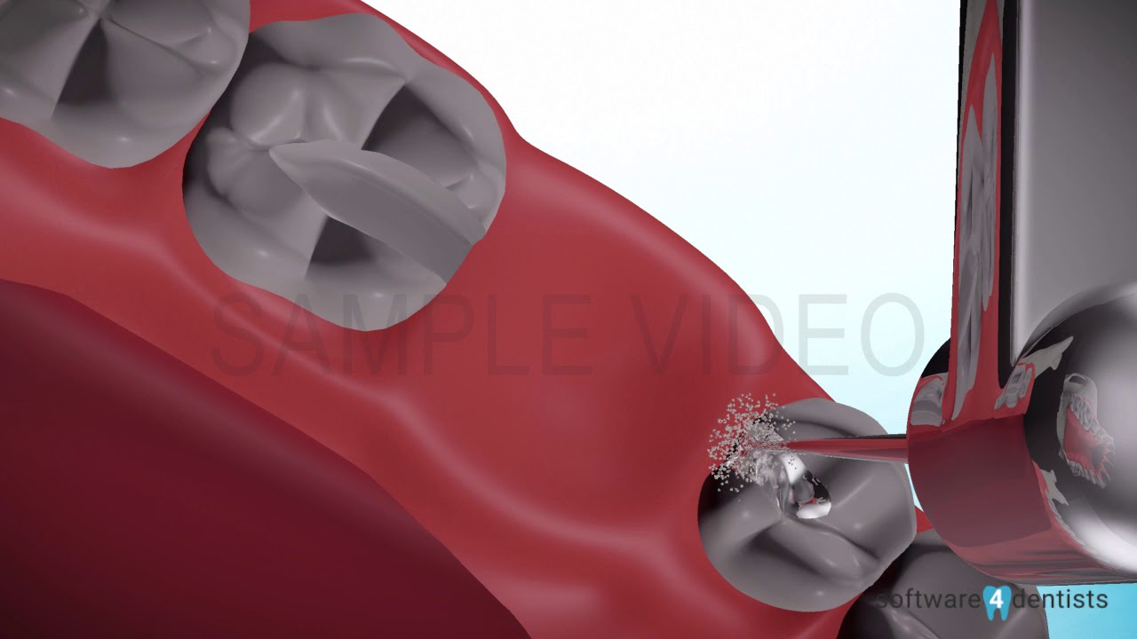 Fibre Bridge dental animation - YouTube
