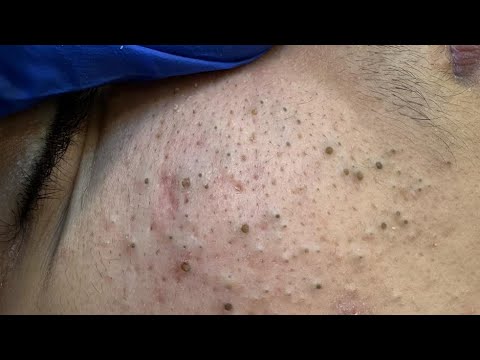 [ASMR] Daily Skincare Routine for Clear Skin, Blackhead Removal and Deep Pore Cleansing