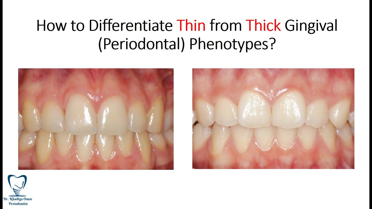 How to Differentiate Thin from Thick Gingival (Periodontal) Phenotypes ...