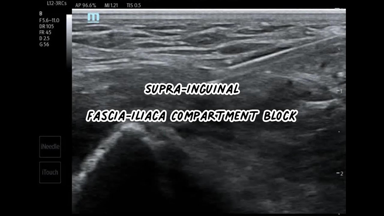 Supra Inguinal Fascia-Iliaca Block (SIFI Block) - YouTube