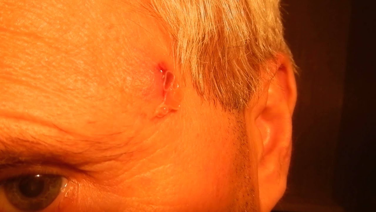 Parasite worm Dirofilaria Repens,Fadenwurm,exiting the Head alive ...