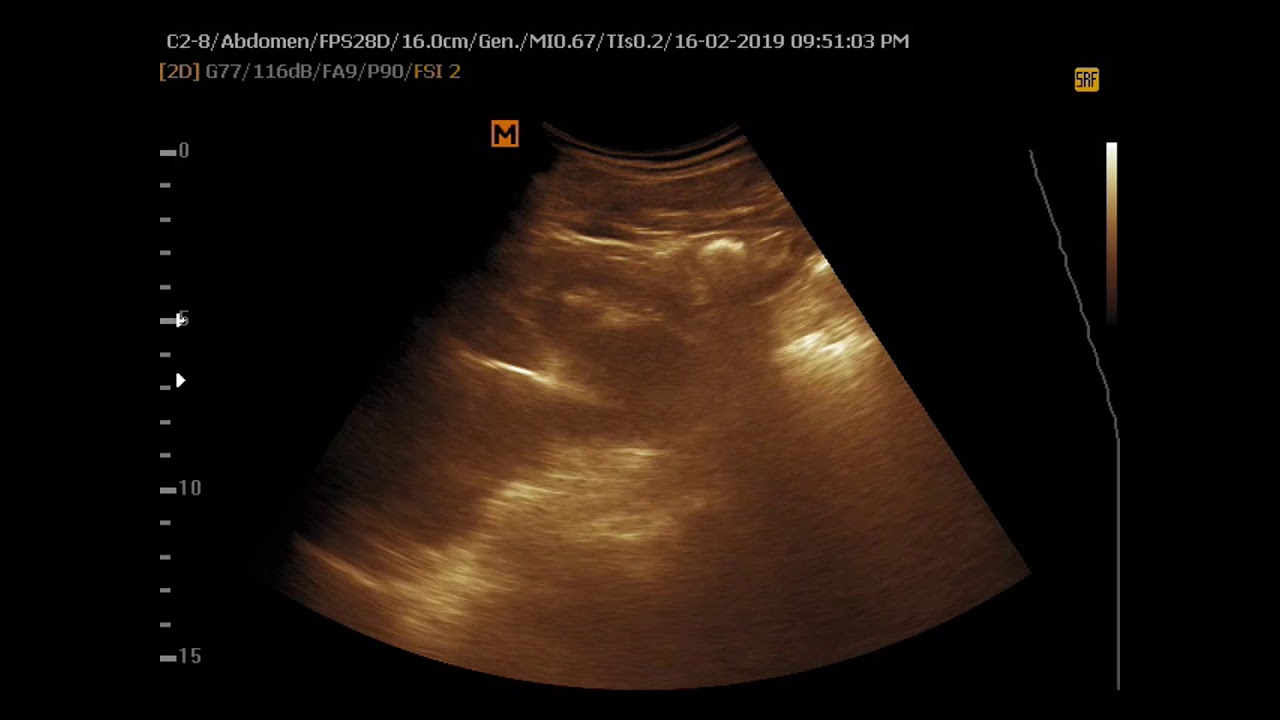 Ultrasound cases 368 of 2000 || Bilateral Hydro nephrosis Right renal ...