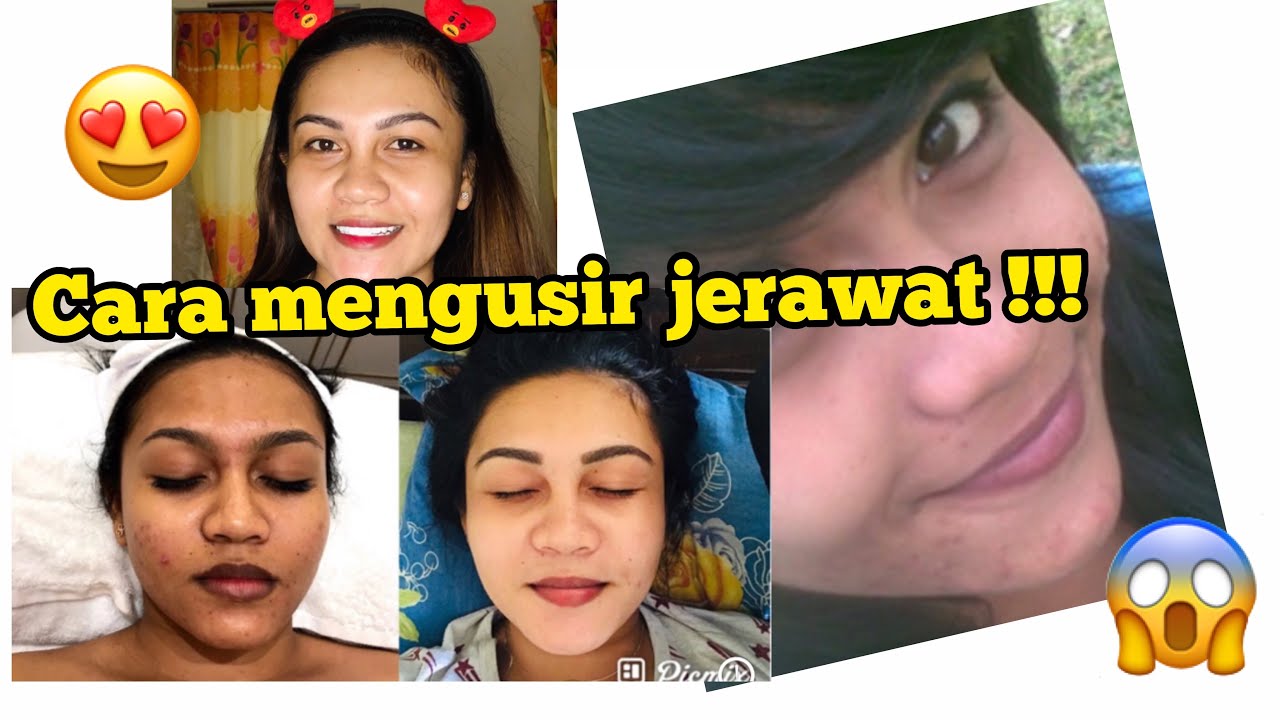 Jerawat batu || jerawat parah sembuh total - YouTube