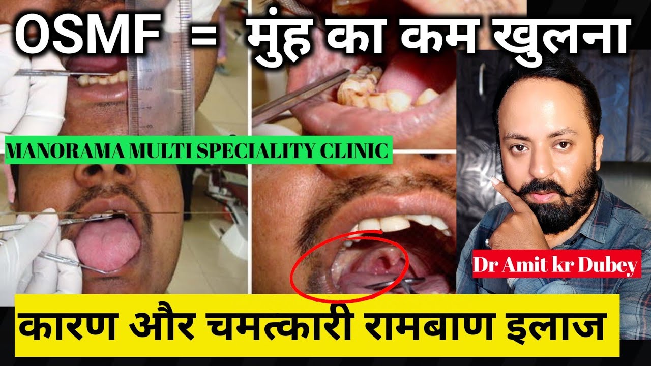मुंह का कम खुलना ||कारण और इसका रामबाण इलाज ||OSMF Exercise || Less ...