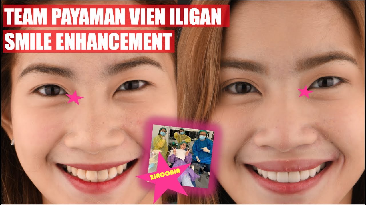 Zirconia Natural Looking Smile Enhancement with Vien Iligan of Team ...
