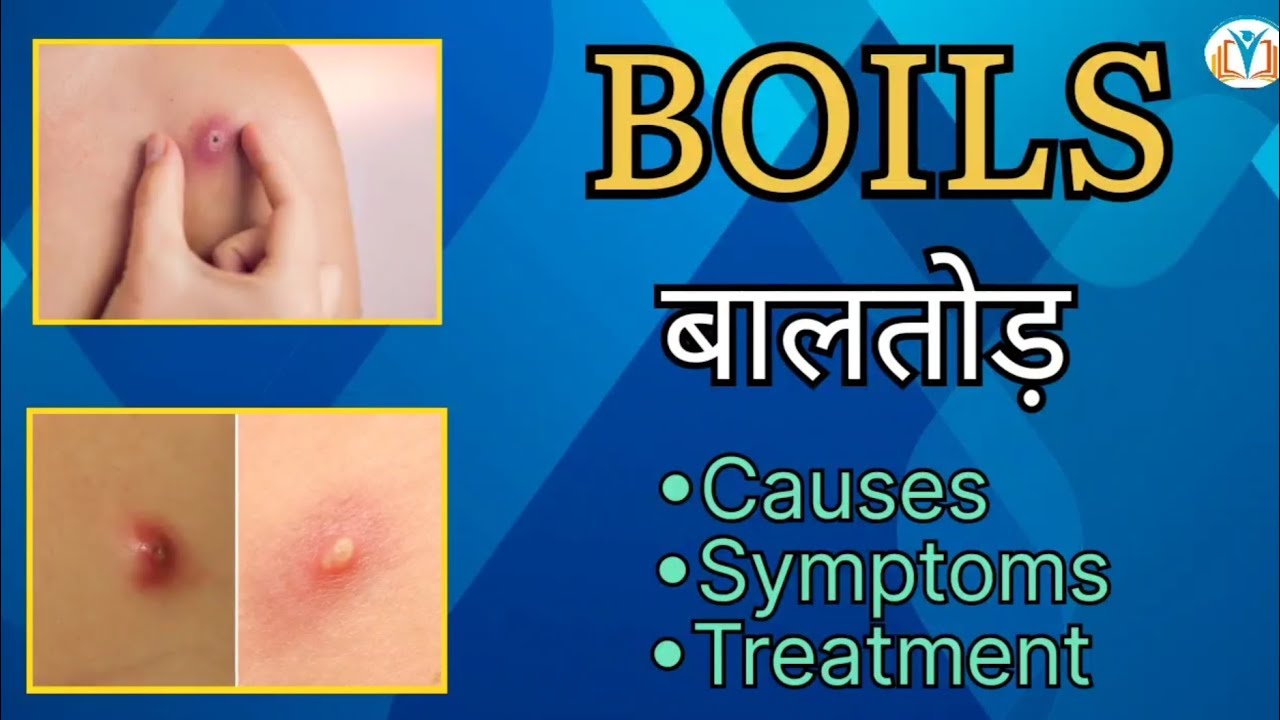 BOILS / FRUNCLE - SURGERY (बालतोड) Boils Treatment at Home - YouTube