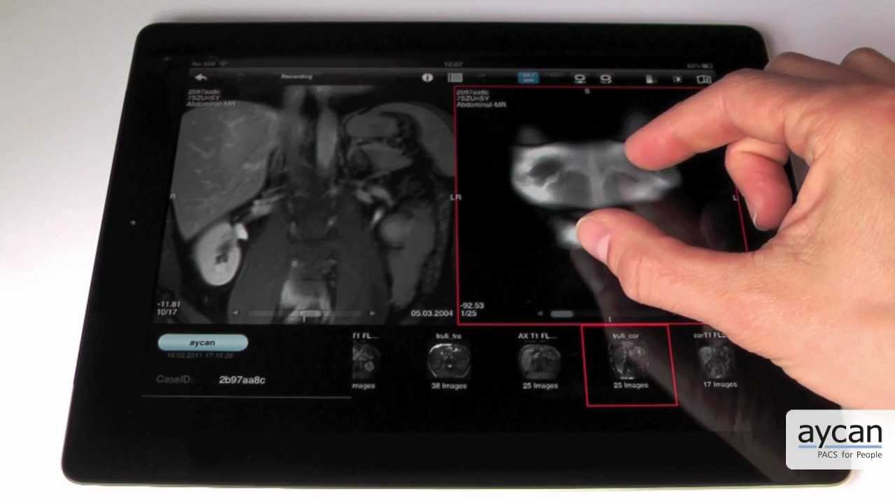aycan mobile iPad App for PACS / Teleradiology - YouTube