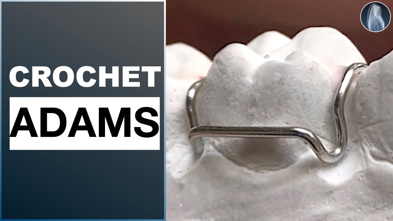 Apprendre à façonner un crochet Adams pour la conception d’une orthèse ...
