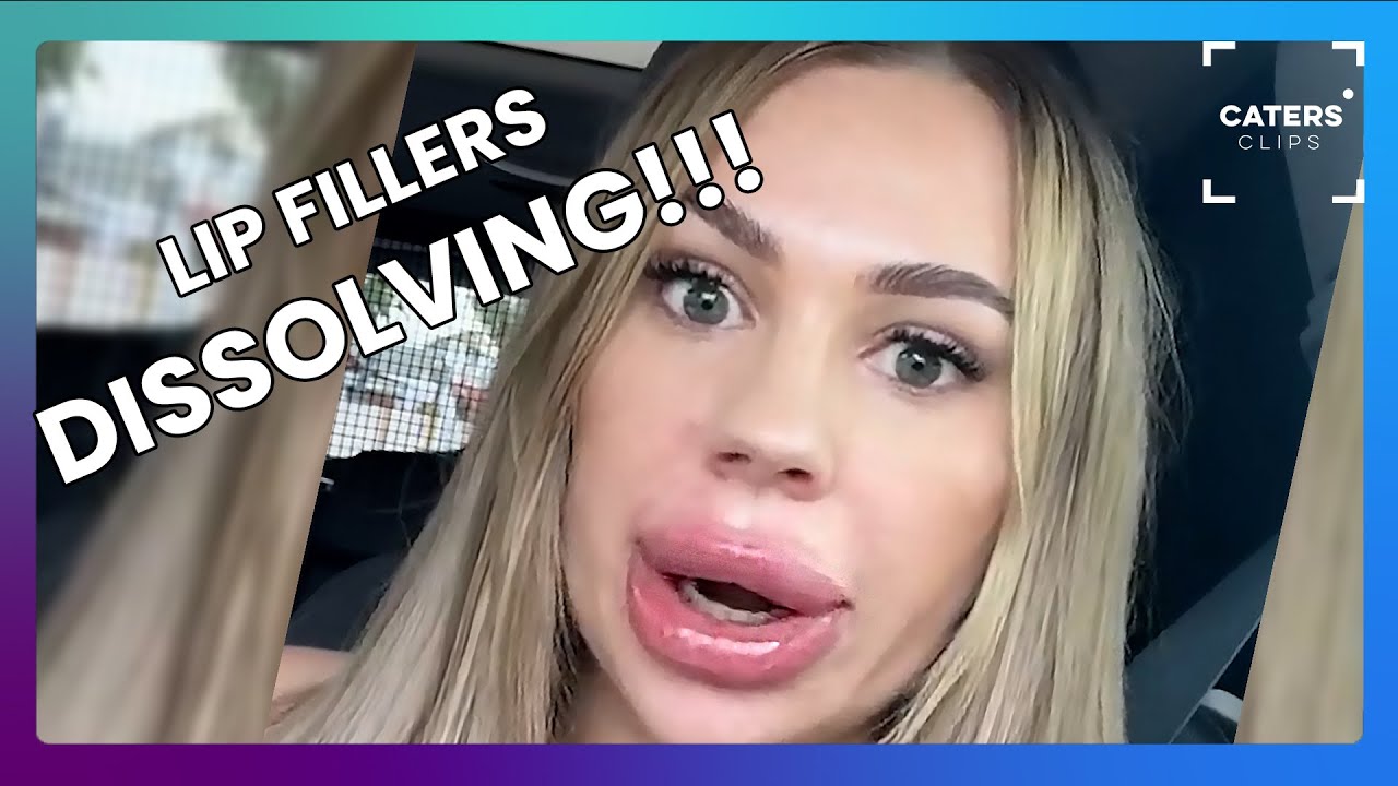 The STRUGGLES Of Getting Your Lip Filler Dissolved - YouTube