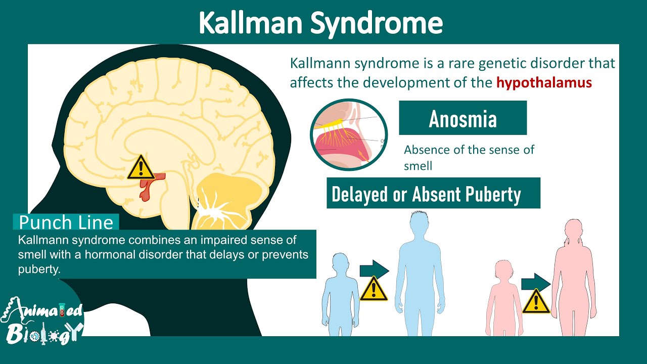 Kallman syndrome | Cause and treatment of Kallman syndrome - YouTube