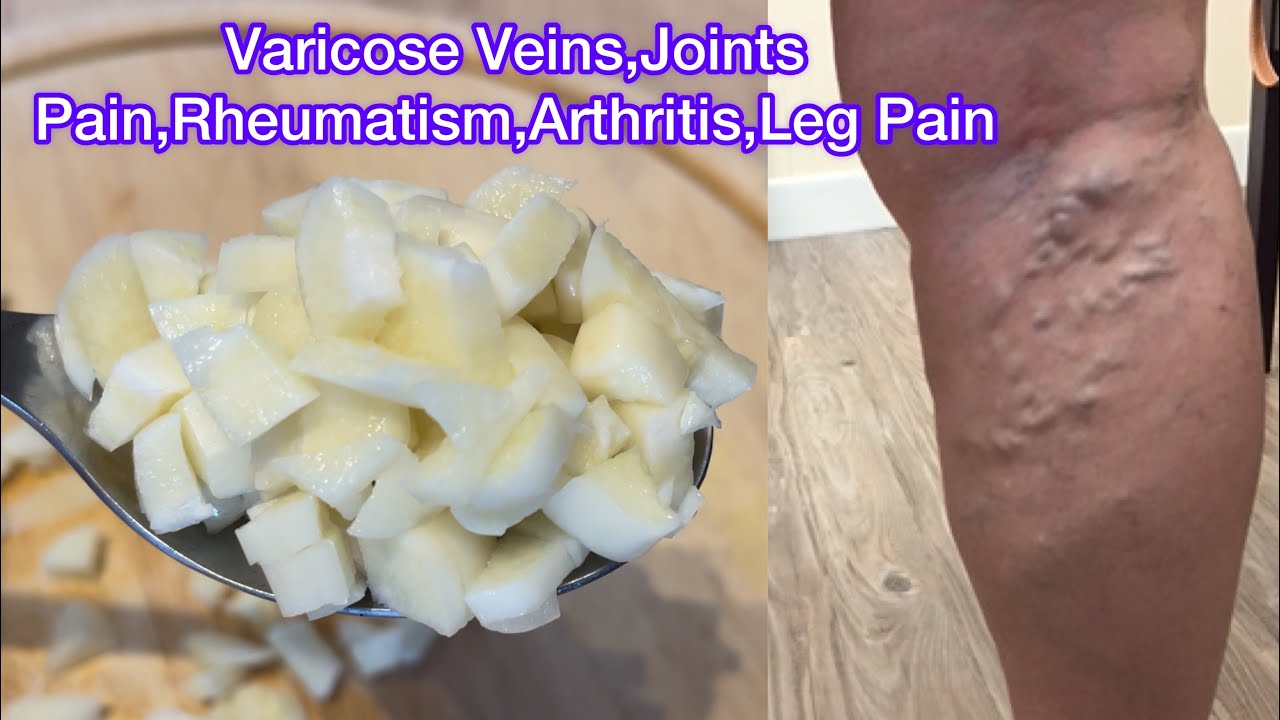 Leg Pain,Rheumatism,Varicose Veins,Arthritis,Joint Pain.Natural Remedy ...