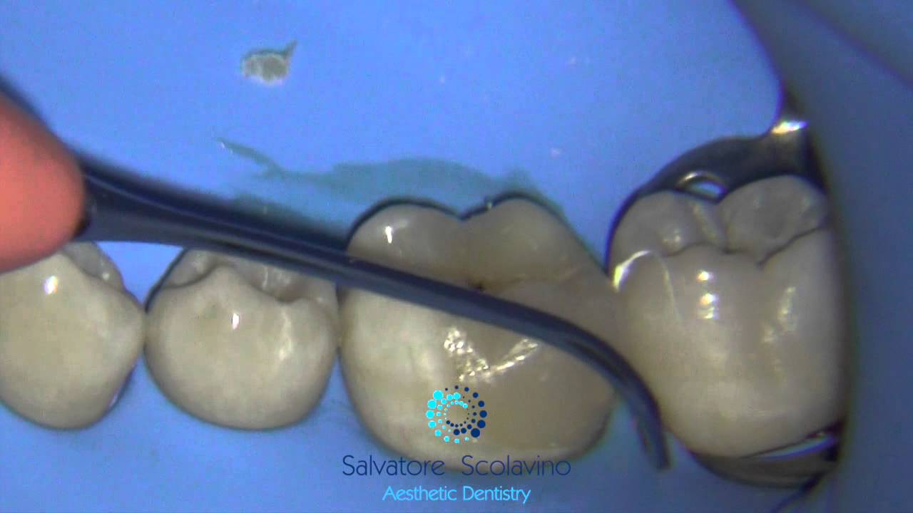 Onlay Cementation - YouTube