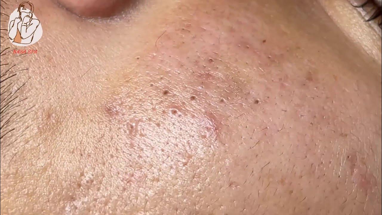 Satisfying And Relaxation With Nasa Beauty Spa 15 Black Point And Acne