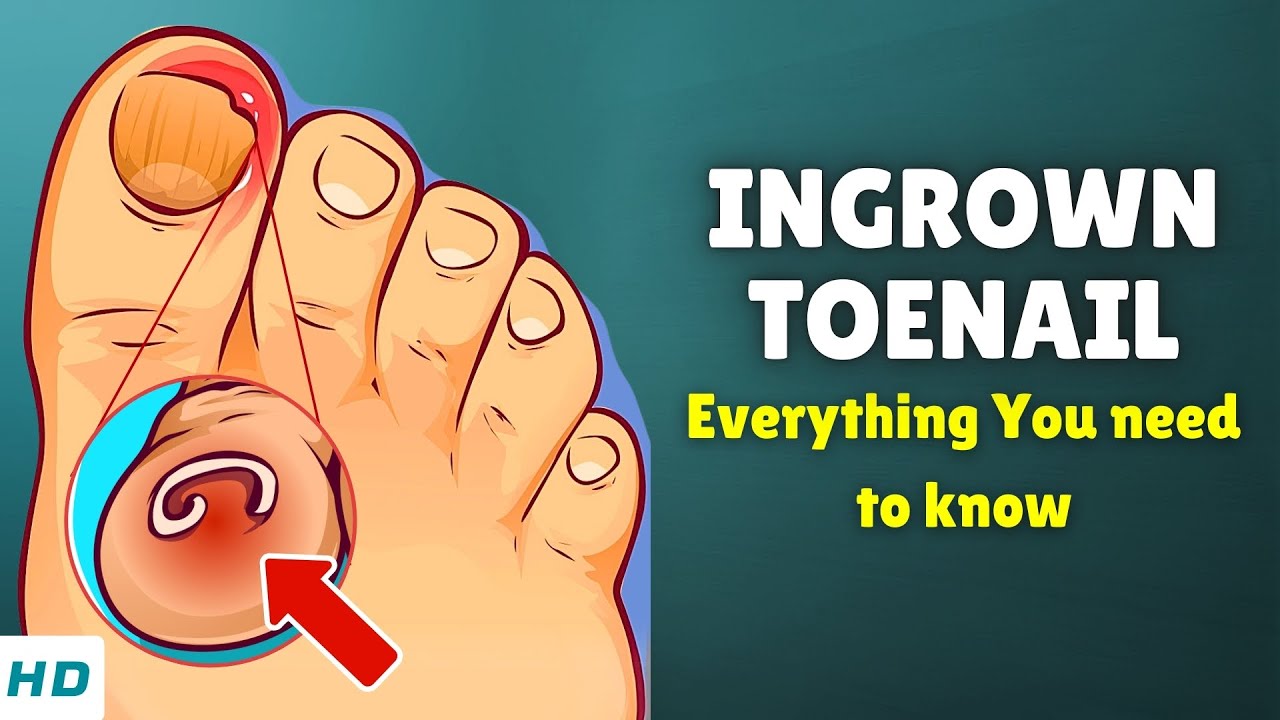 Ingrown Toenail? Causes, Signs and Symptoms & 5 Home Remedies to Fix It ...