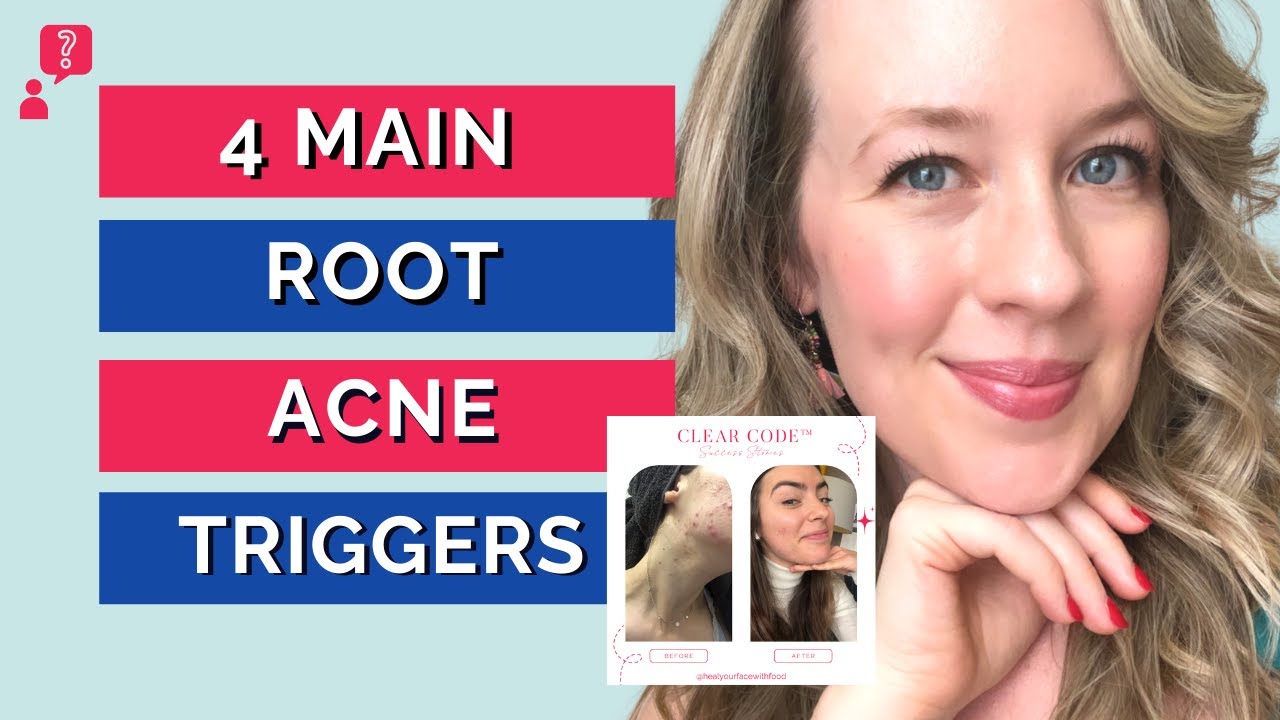 Why am I breaking out? 4 MAIN ROOT ACNE TRIGGERS - YouTube