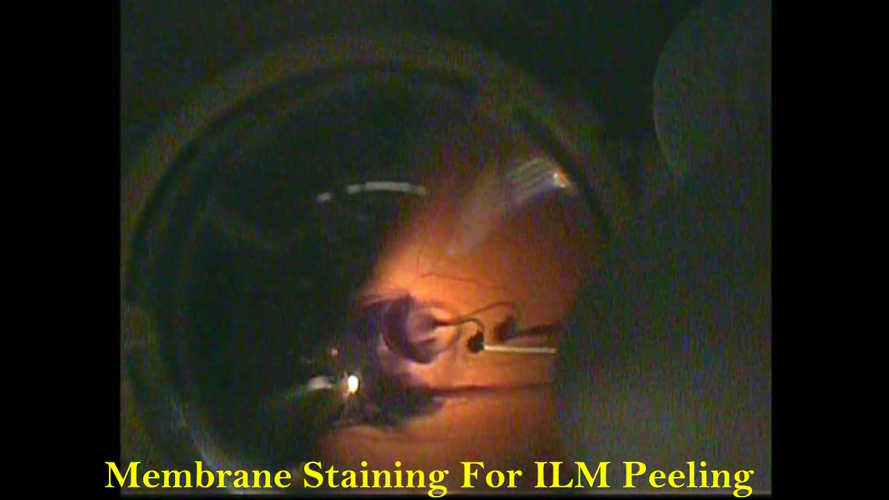 Tractional Retinal Detachment TRD (MAKKAH HOSPITAL-SUDAN( - YouTube
