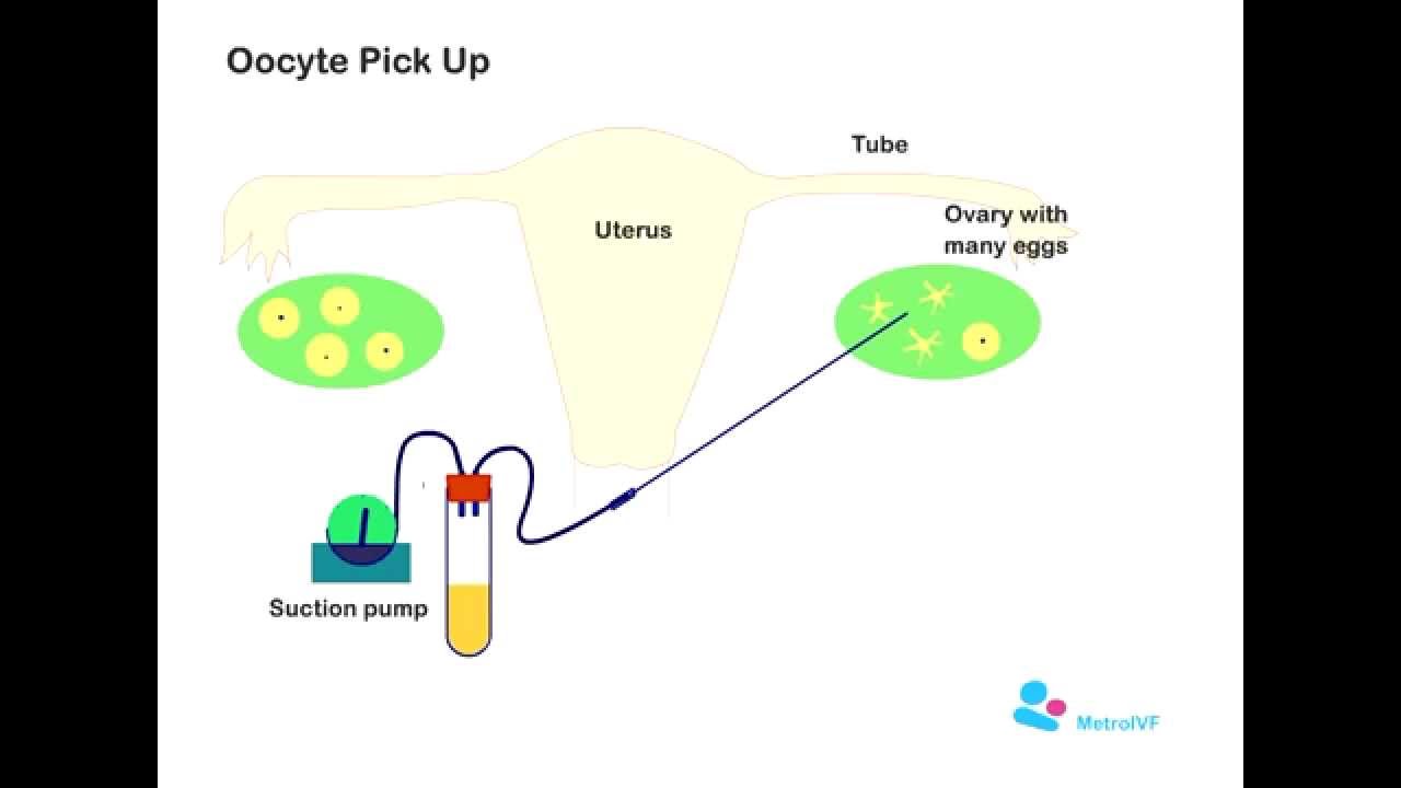 Oocyte Pick Up - YouTube