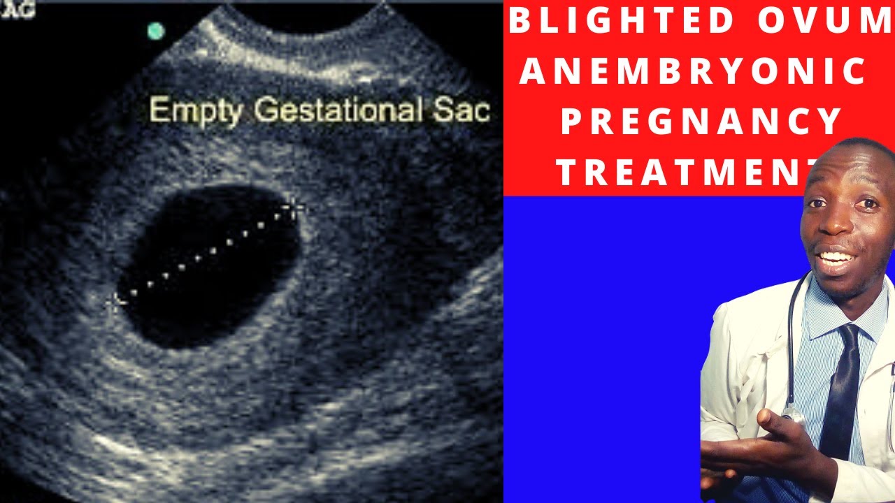 Anembryonic Pregnancy Treatment I Blighted Ovum (Empty Gestation Sac) I ...