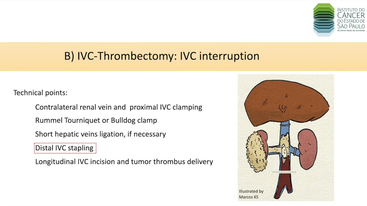V11-01: Laparoscopic and Robot-assisted Level II and III Inferior Vena ...