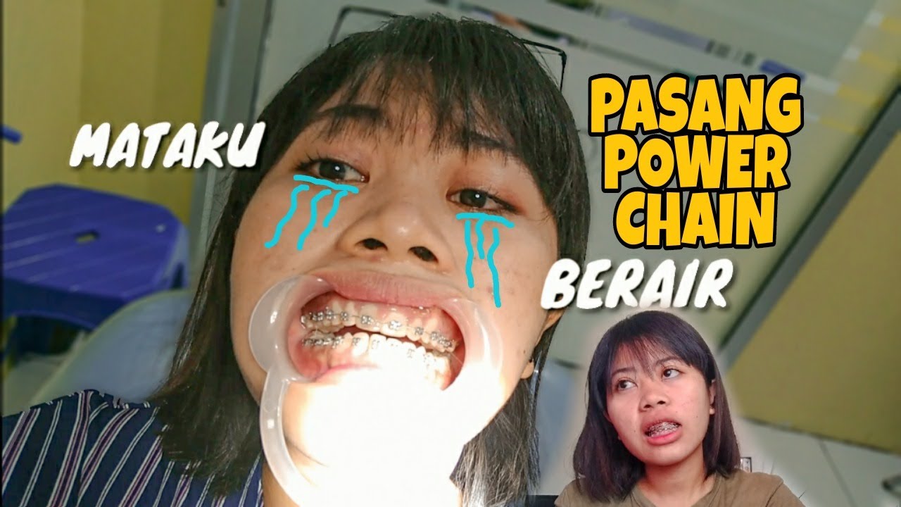 PROSES PASANG KARET POWER CHAIN, UNTUK MUNDURIN GIGI MAJU - YouTube