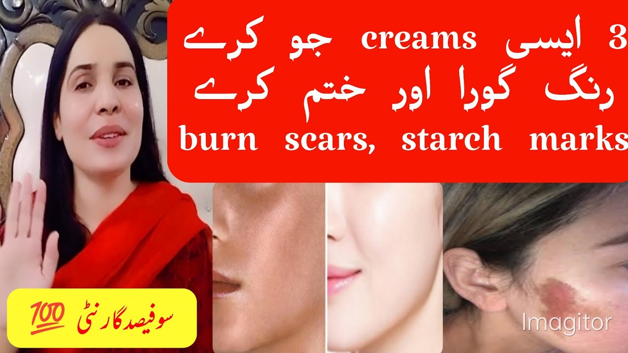 whiting creams for fair complexion,burn scars,stretch marks,for ...