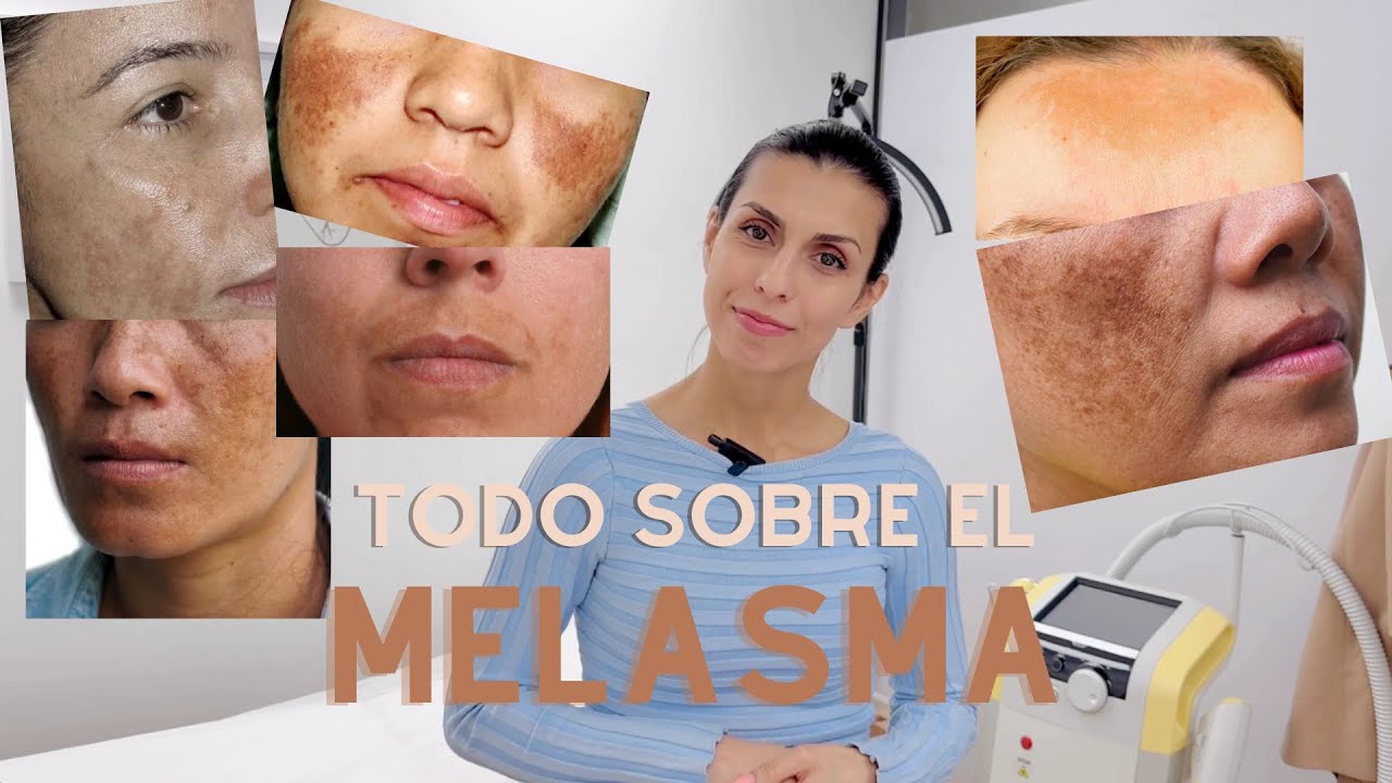 ¿Qué es el melasma y cómo se trata? - YouTube