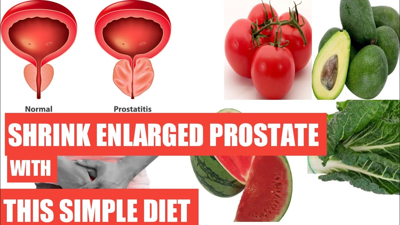 BEST FOOD &FRUITS AND VEGETABLES TO SHRINK ENLARGED PROSTATE - YouTube