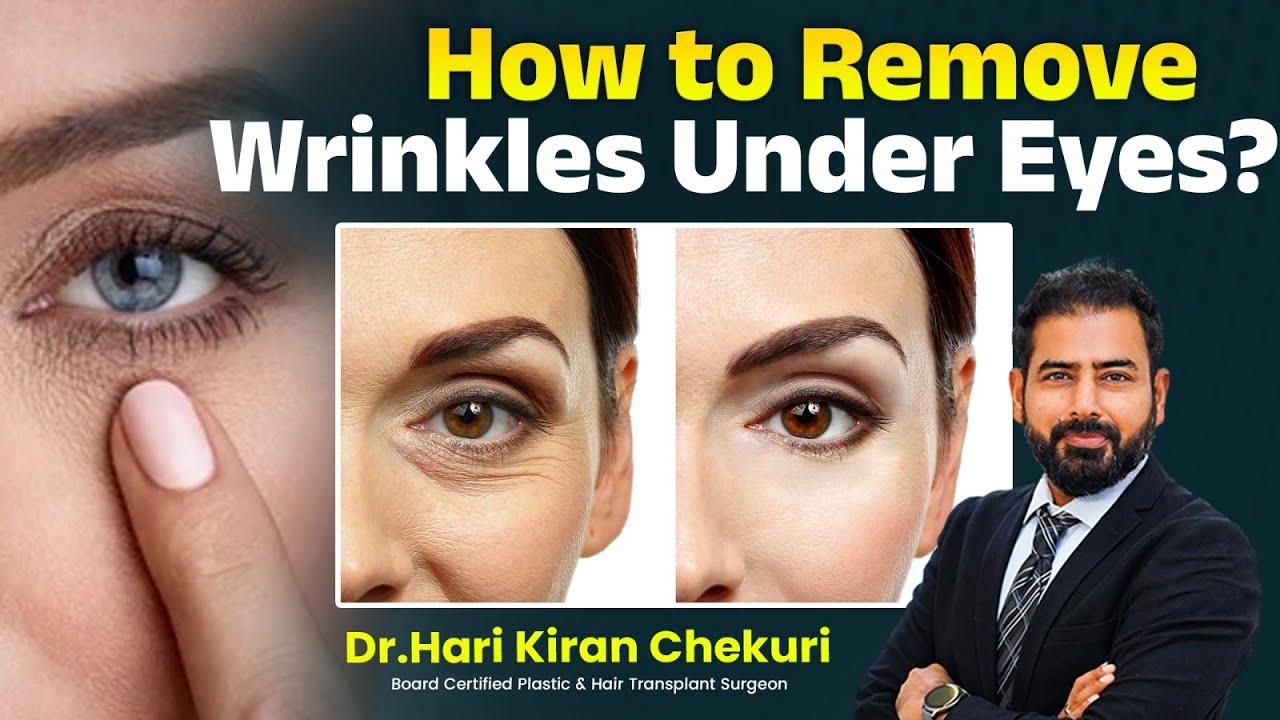 How to Remove Wrinkles Under Eyes || Best Treatment for Wrinkles Under ...
