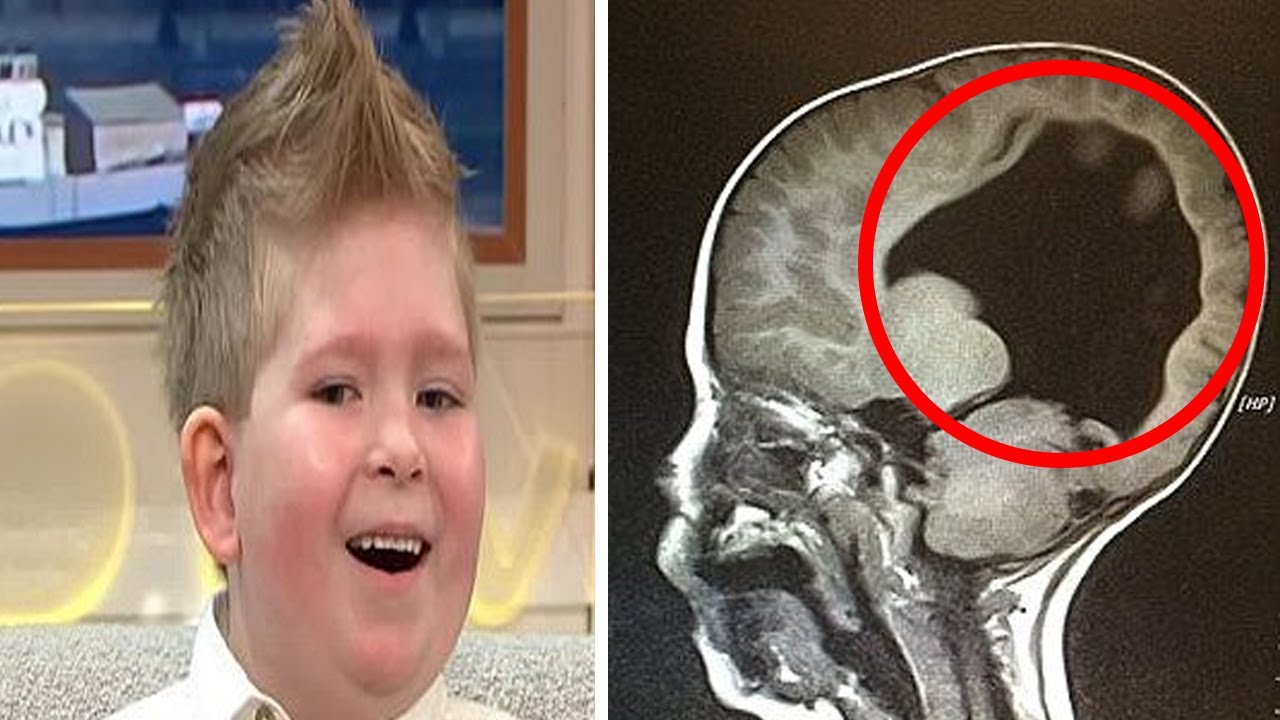 Boy Born Without A Brain, 6 Years Later Look At What Doctors Find ...