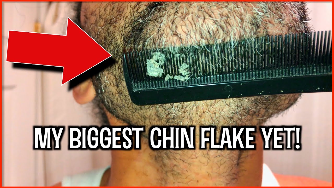 My Biggest Flake Yet | DANDRUFF FLAKES | SEBORRHEIC DERMATITIS ...
