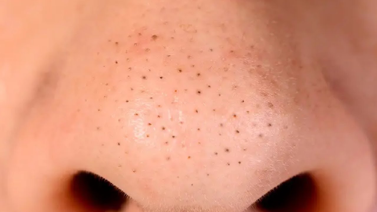 how to get rid of blackheads on nose permanently at home - YouTube