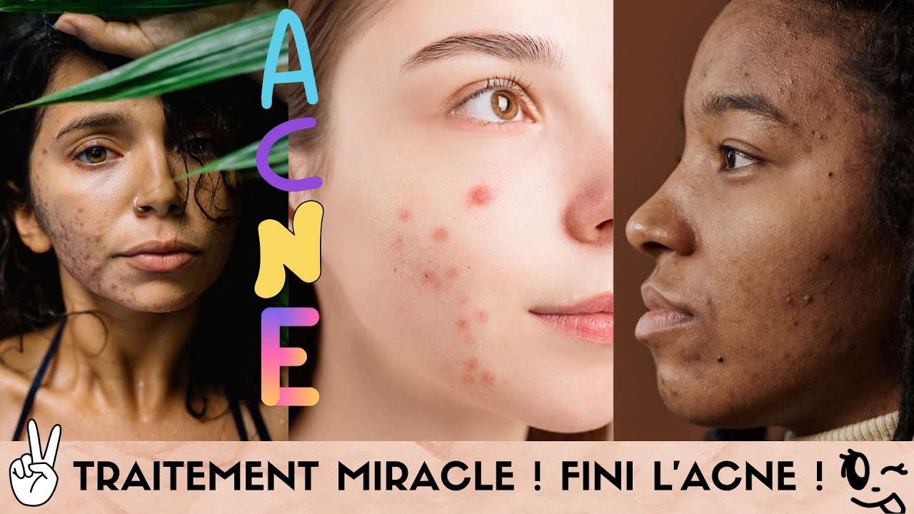 😎 ACNE : comment s’en débarrasser FACILEMENT. Alimentation et ...