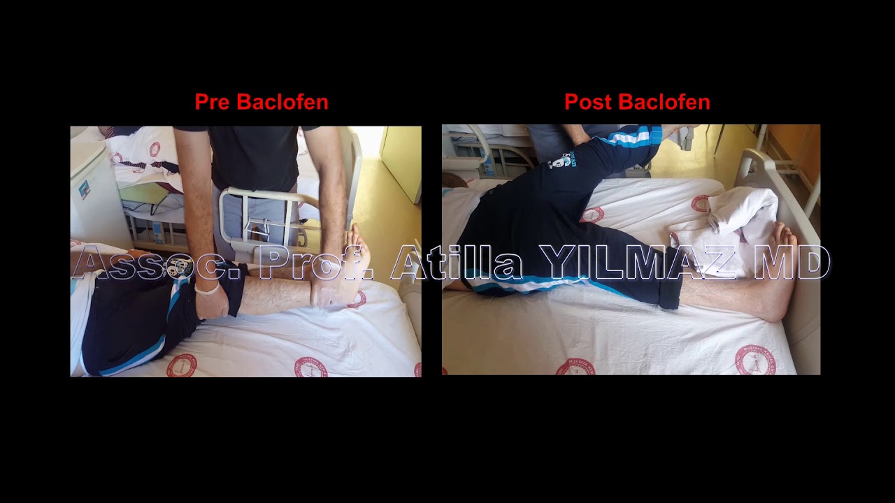 Baklofen pompası ameliyatının etkisi - YouTube