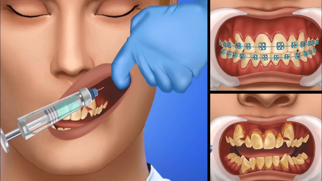 ASMR Satisfying symbios socket preservation | Teeth cavity treatment ...