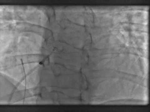 Pfo Closure with Gore Helex 25 mm - YouTube