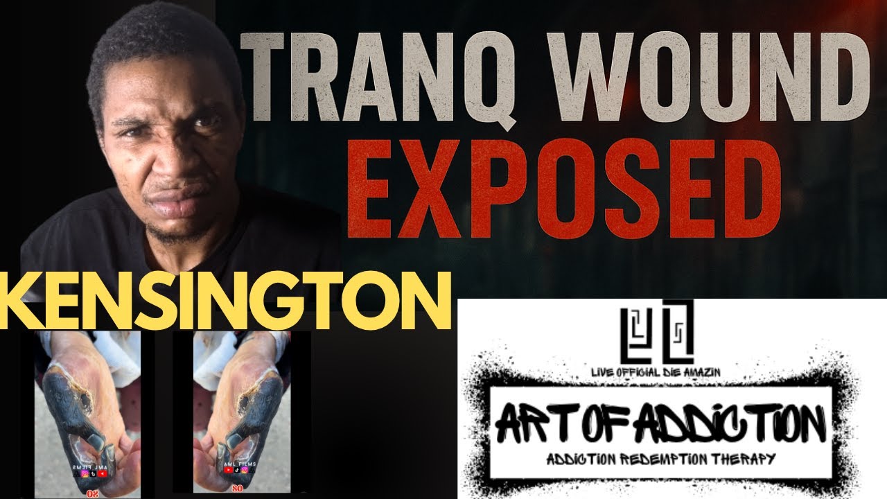 Philadelphia’s Tranq Epidemic Exposed | The New Face of Addiction - YouTube