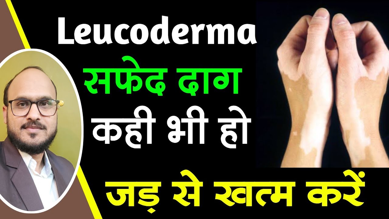 Leucoderma | सफेद दाग Best Homeopathic Treatment - YouTube
