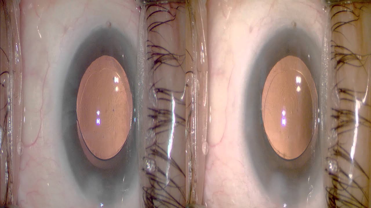 Cataract Surgery IOL positioning in 3D - YouTube