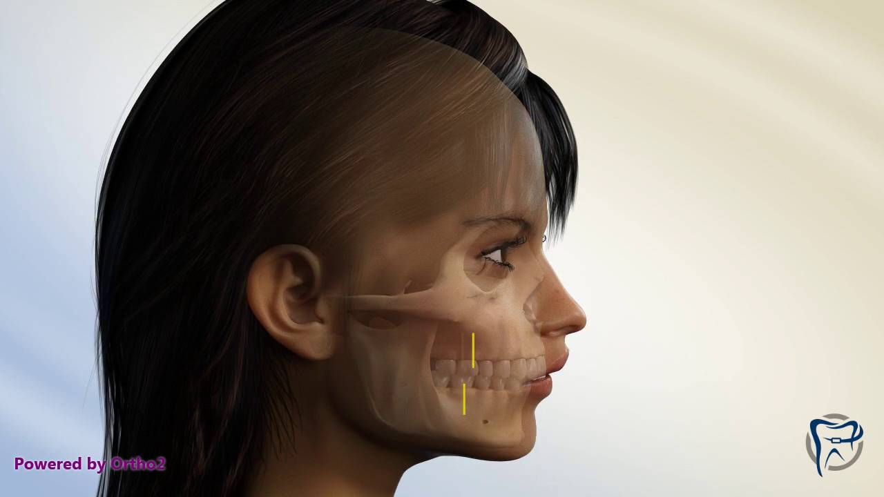 Class II Bite Cause 2 - YouTube