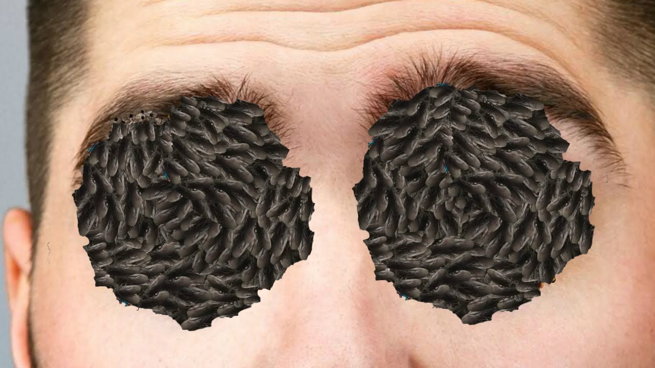 ASMR Eye Treatment Infected With Maggots, Insects, & Pustules Cleaning ...