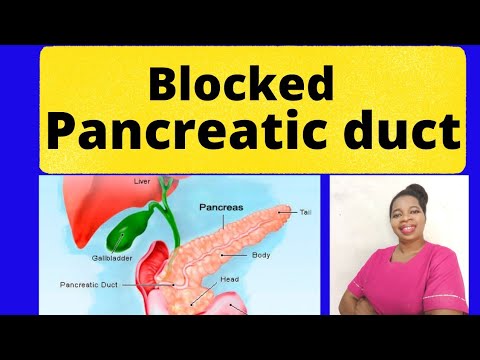 Blocked pancreatic duct (signs and symptoms) - YouTube