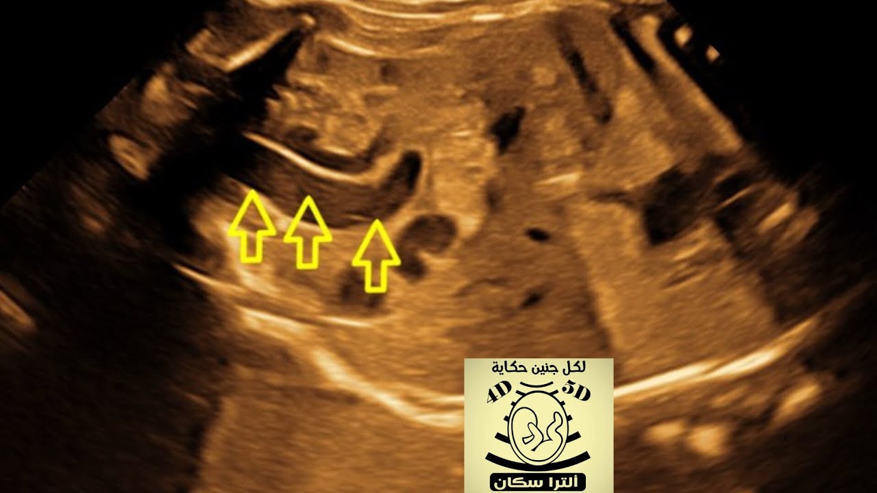 imperforate anus fetal ultrasound - YouTube