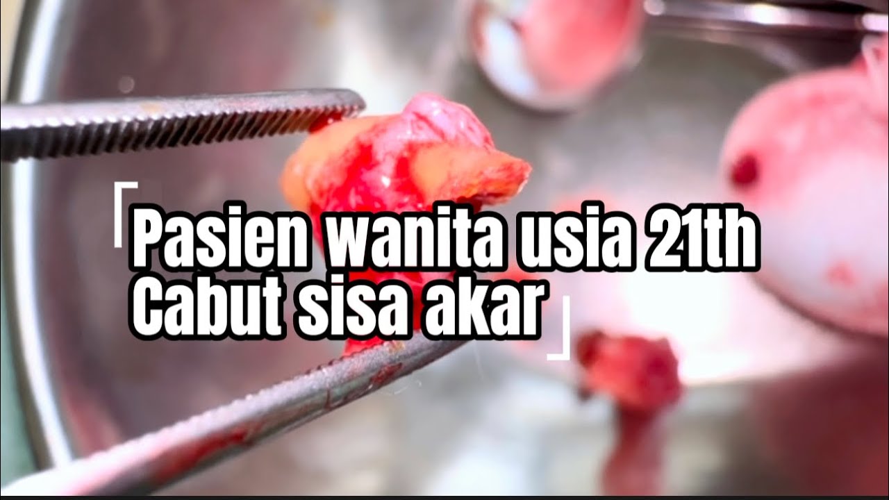 Gigi berlubang | Sisa akar gigi | Cabut Gigi | Dokter Gigi - YouTube