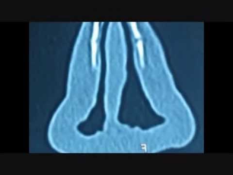 Alar Collapse Correction - Snoring Treatment - YouTube