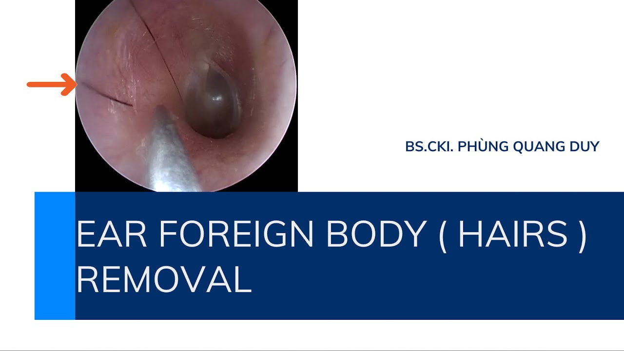 EAR FOREIGN BODY ( HAIRS ) REMOVAL - DỊ VẬT TAI - YouTube